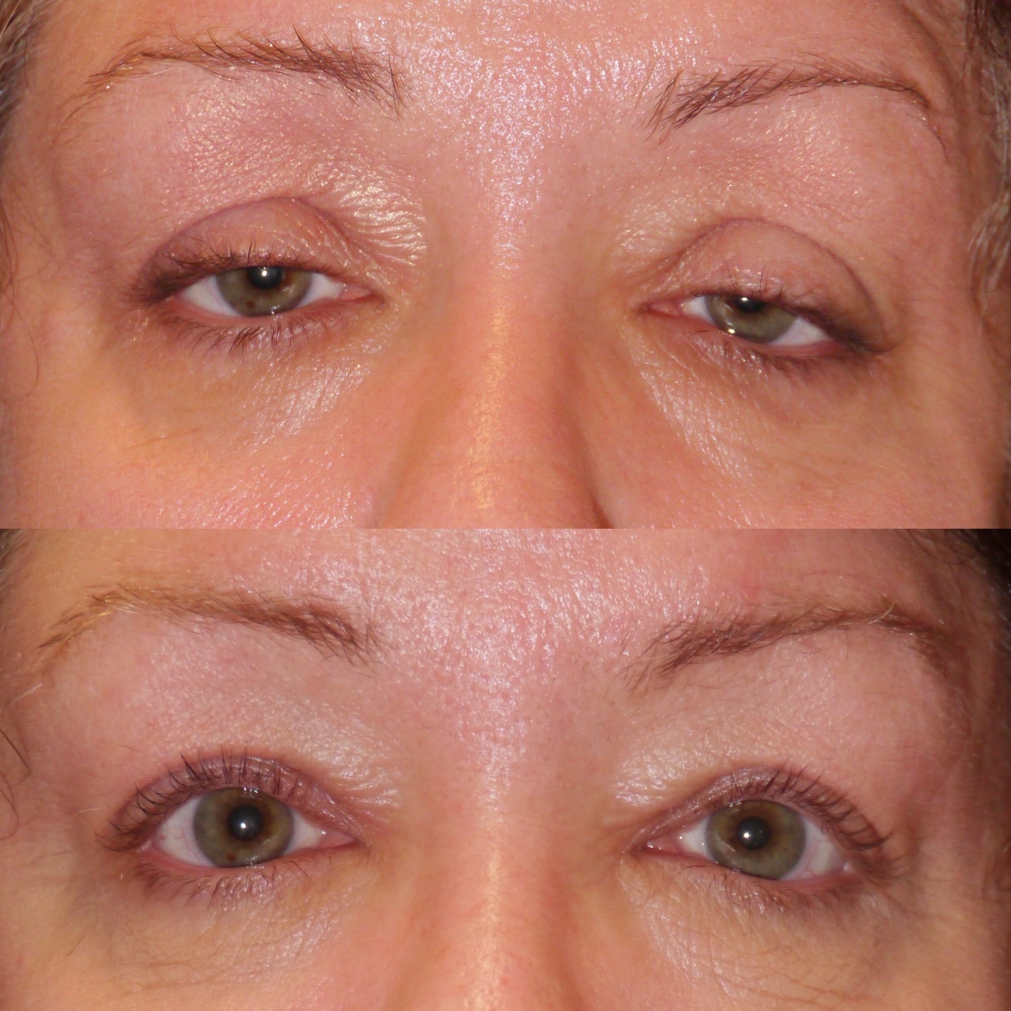 Ptosis Surgery Arlington Tyson VA Ptosis Surgery Arlington Tyson VA